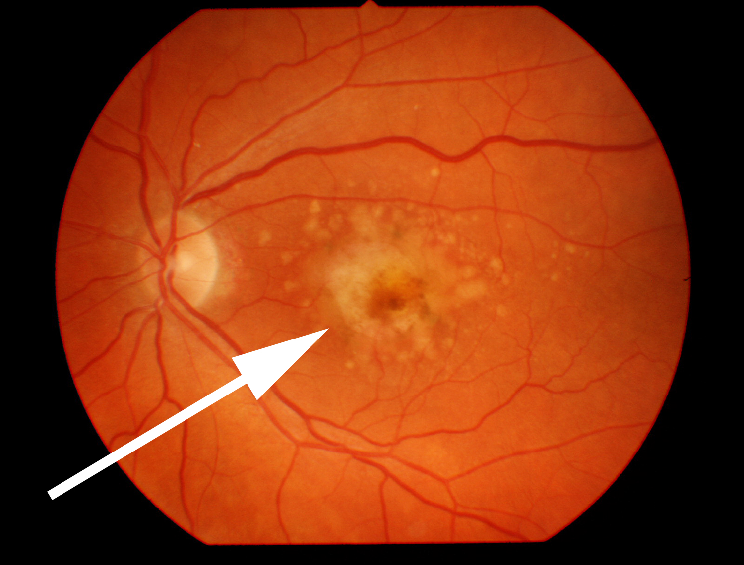 Blind Spots | Macular Degeneration Foundation