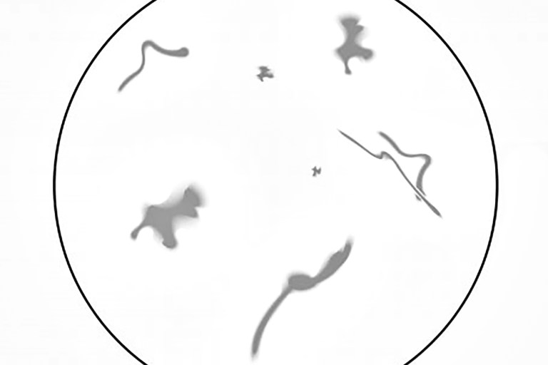 Those Annoying Floating Specks in Your Vision | Macular Degeneration ...