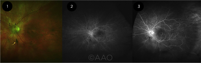 Brolucizumab and Retinal Vasculitis | Macular Degeneration Foundation