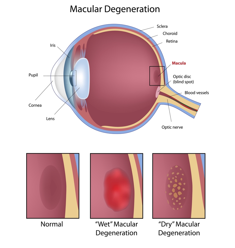 What Do I Do? … My Doctor just told me I have Macular Degeneration ...