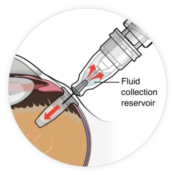 New “Wet” AMD Medication Delivery System | Macular Degeneration Foundation