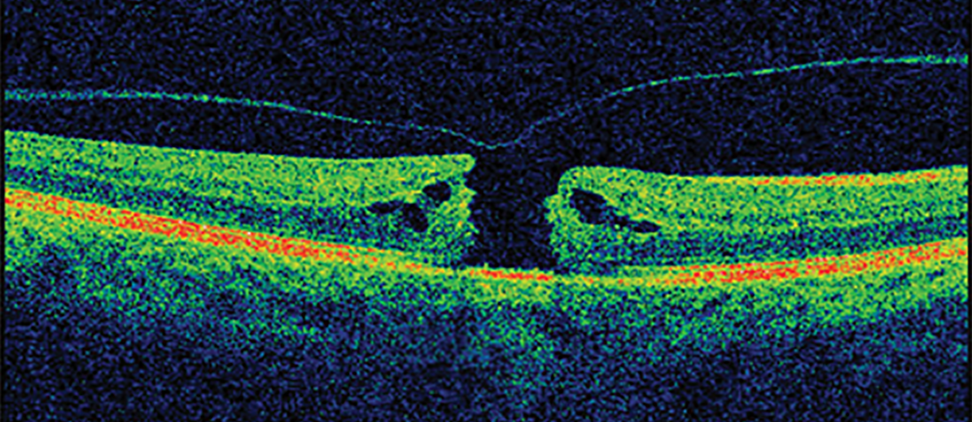 Macular Hole Repair | Macular Degeneration Foundation